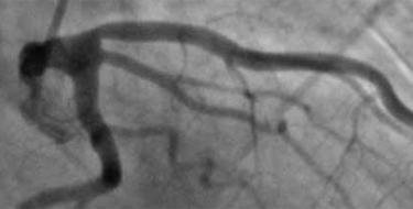 Coronarographie/ coroscanner - Quelles complications ? - Fiches santé ...