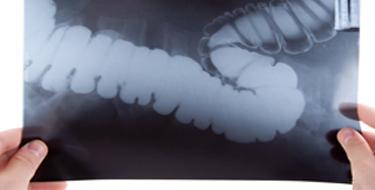 Chirurgie de l'intestin grêle - Libération de brides - Fiches santé et ...