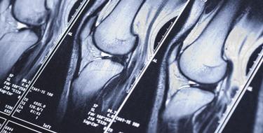 Gonarthrose - Qu’est-ce que la gonarthrose ? - Fiches santé et conseils ...