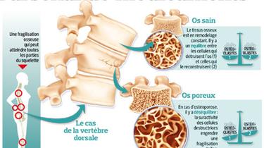 Ostéoporose: un arsenal de médicaments se développe