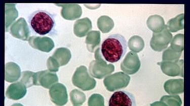 Des cellules «tueuses» au secours d'une leucémie
