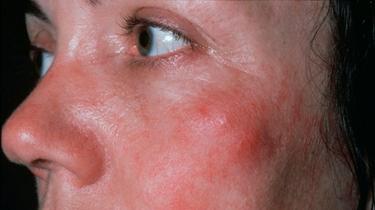 Le lupus : mieux compris et mieux traité