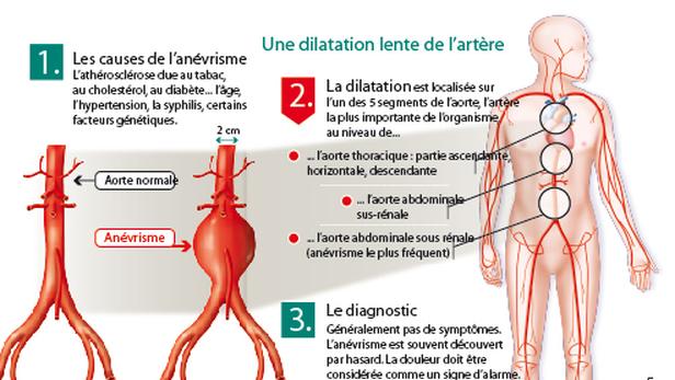 L'enjeu du dépistage de l'anévrisme de l'aorte