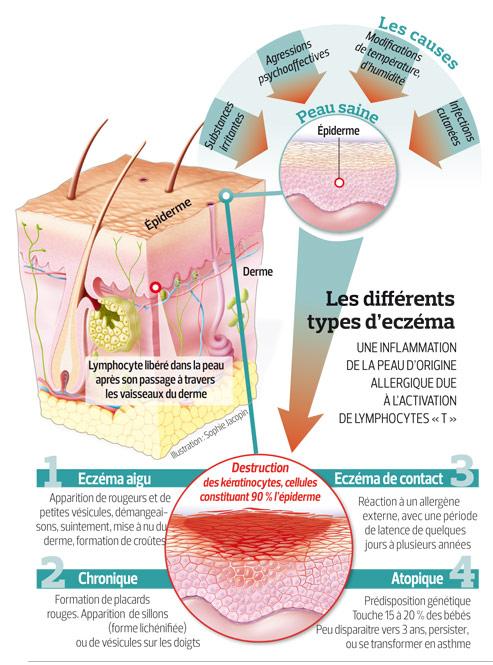 Eczéma, les cas augmentent dans les pays industrialisés
