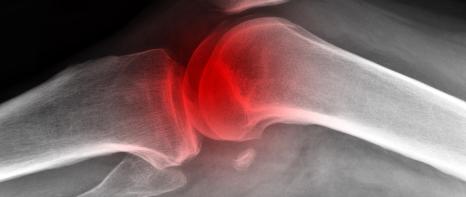 Cancer des os - Quels signes et symptômes ? - Fiches santé et conseils ...