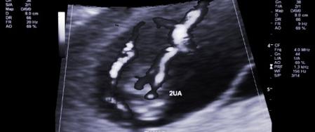 Echographie prostatique par voie endorectale - Quelles indications ...
