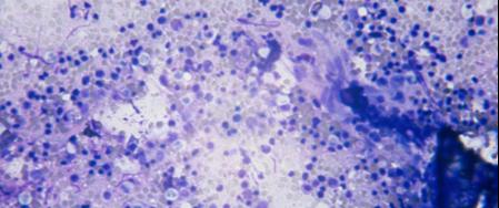 Myélogramme - Quels sont les résultats du myélogramme ? - Fiches santé ...