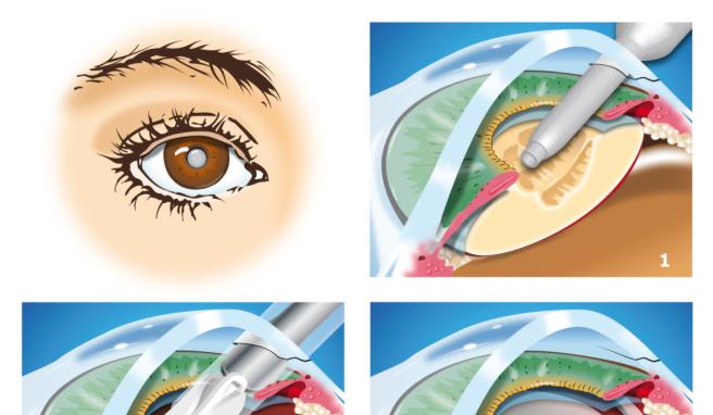 Décollement de la rétine - Comment vivre avec ? - Fiches santé et ...
