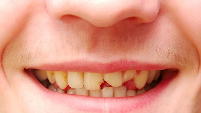 Dents cassées - Qu’est-ce que c’est ? - Fiches santé et conseils médicaux