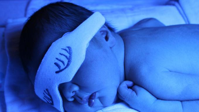 Ictère - Qu’est-ce que c’est ? - Fiches santé et conseils médicaux