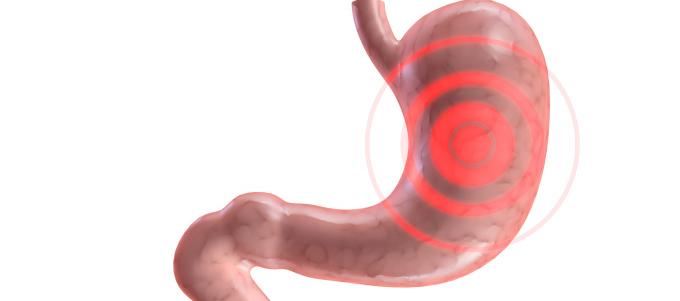 Ulcère gastroduodénal - Qu'est-ce que je ressens ? - Fiches santé et ...