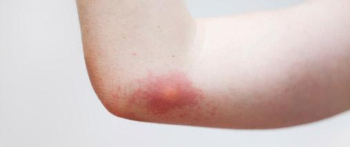 Urticaire - Quelles causes ? - Fiches santé et conseils médicaux