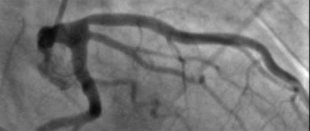 Coronarographie/ coroscanner - Quelles complications ? - Fiches santé ...