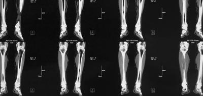 Périostite tibiale - Quel traitement ? - Fiches santé et conseils médicaux