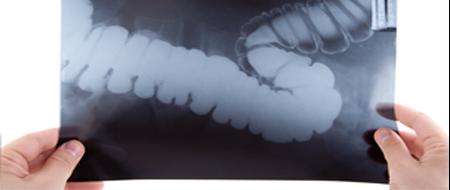 Polypes colo-rectaux - Qu'est-ce que c'est ? - Fiches santé et conseils ...