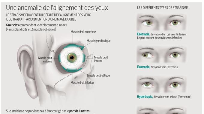 Strabisme - Qu’est ce que c’est ? - Fiches santé et conseils médicaux