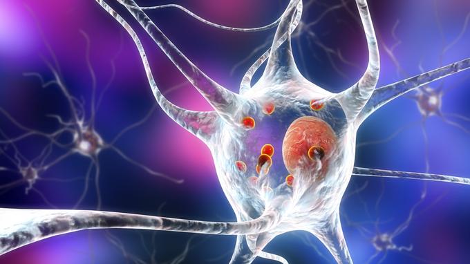 Maladie de Parkinson - Quels examens faire ? - Fiches santé et conseils ... Maladie de Parkinson - Quels examens faire ? - Fiches santé et conseils ...