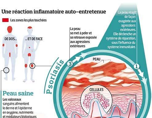 Psoriasis : l'inflammation dans la peau