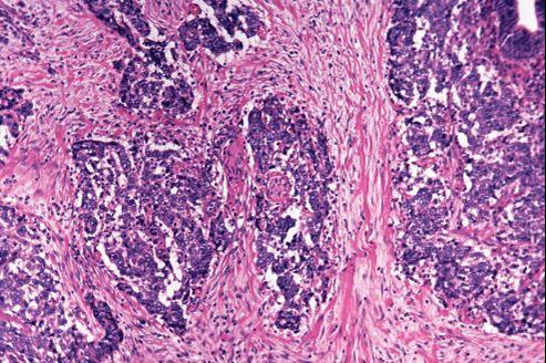 Comment le dentiste dépiste les cancers de la bouche