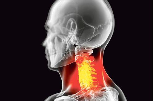 Quelles solutions pour l'arthrose cervicale