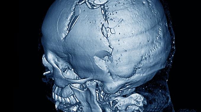 Traumatisme crânien : des degrés de gravité variables