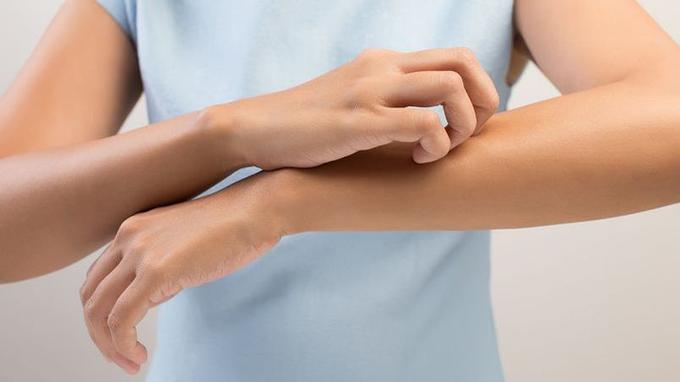 Urticaire : pourquoi est-elle si fréquente
