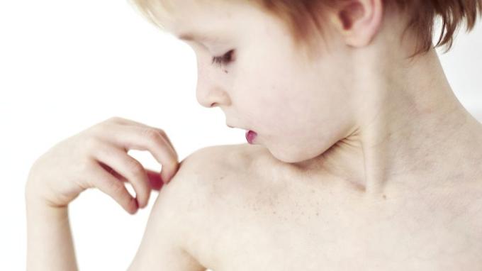 La gale, maladie très contagieuse, est en recrudescence