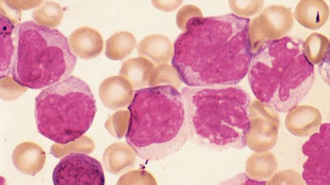 Espoir de guérison pour la leucémie myéloïde chronique