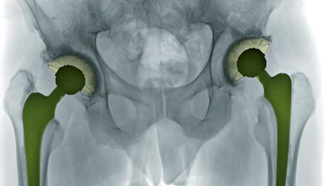 Fracture du col du fémur : opérer le plus vite possible