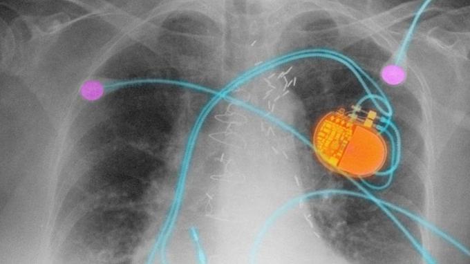 Comment bien vivre avec un implant cardiaque