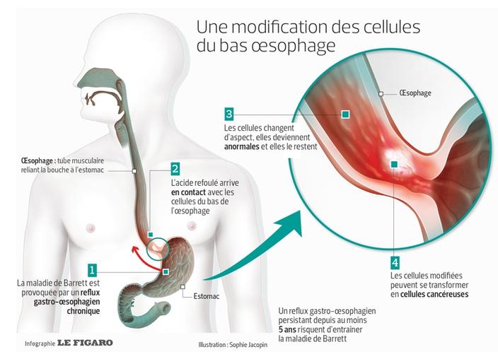 Cancer de l'œsophage : les signes à surveiller