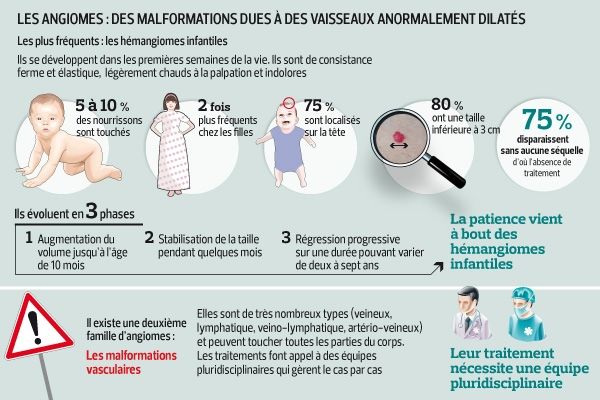 Des traitements personnalisés pour soigner les angiomes