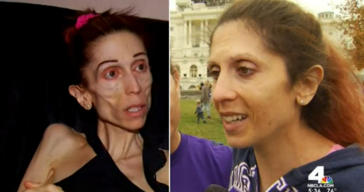 L'incroyable transformation d'une femme victime d'anorexie morbide ...