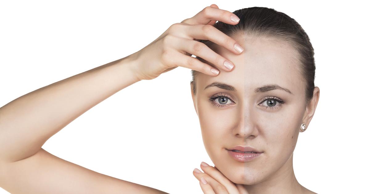 Acné : zoom sur les différents types de boutons